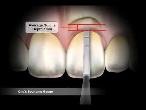 Chu's Sounding Gauge