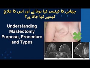 Mastectomy Understanding | Purpose | Procedure | Types | Overviewfor Nursing and Medical Students.