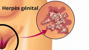 Herpès génital: causes, transmission, symptômes et traitement. | A votre santé - Dr Kenfack