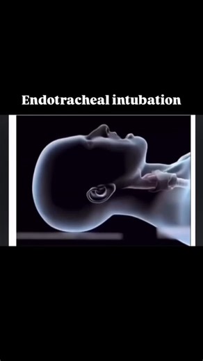 BL HOMOEOPATHIC HOSPITAL AND RESEARCH CENTRE on Instagram: "Endotracheal intubation is a medical procedure in which an endotracheal tube is inserted through the mouth or nose into the trachea to maintain airway #explorepage✨ #viralvideos #medicalstudent #endotrachealtube"