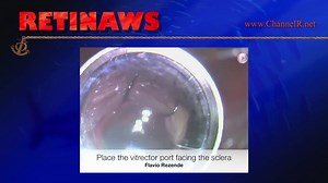 Expulsive Suprachoroidal Hemorrhage - Eyetube