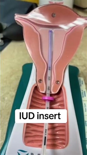 IUD insertion simplified