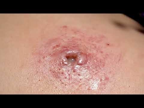 Massive Blackhead Removal | Satisfying Deep Extraction