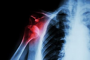 Shoulder Instability and Chronic Dislocation