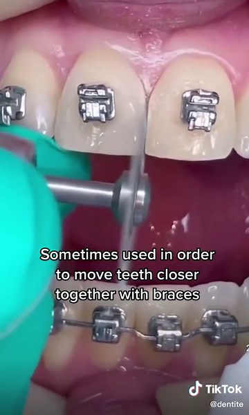 Interproximal Reduction (IPR) for Braces: Shaving Down Teeth