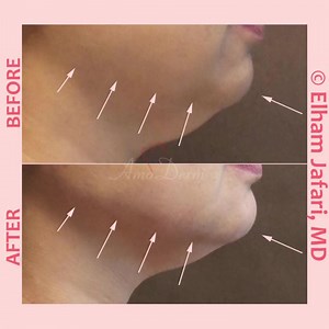 👁 Nonsurgical chin augmentation and Jawline Contouring __ 💉 Procedure: Dermal filler injection performed by experienced MD __ 🎯 Purpose: Reshaping chin to correct poorly-defined and underprojected chin and sculpting and reconstructing jawline to achieve a more beautiful and balanced look and contour without surgery or down-time __ 💊 Products used: Various dermal fillers can be used, but for best results, we recommend Voluma. The optimal combination of fillers will be determined during your c