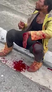 Dude Gets His Hand Chopped Off With Machete