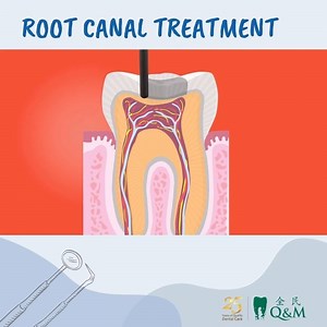 Thinking about doing a root canal? 🤔 . Here's a step-by-step animation to alleviate any apprehension you might have. . Your dentist will first remove the decay and make a small opening at the top of the tooth. Using this opening, he or she will remove the damaged tissue, thoroughly clean and disinfect the canals before sealing it with fillings. A crown is then placed on top to protect and restore the tooth. With proper restoration and dental care, your root canal may last for a lifetime! 😇✨ . 