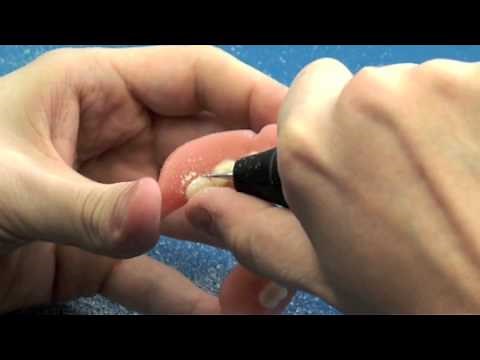 Ausarbeiten einer Prothese