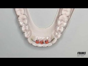Bonded Retainer Demo with Indirect Bonding by ‪@AltaSmiles‬