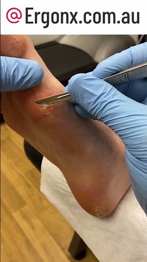 Amazing Thick Forefoot Callus Removal by Podiatrist #Podiatry #CallusCare