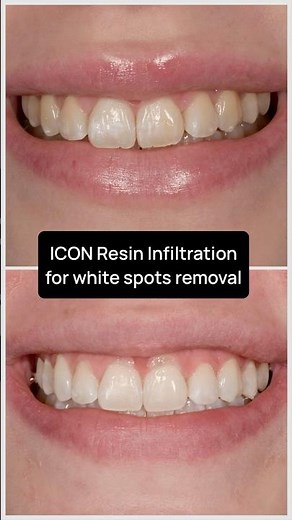 ICON resin infiltration (for white spot removal)
