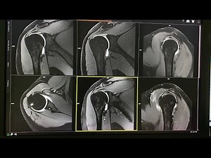 MRI Right Shoulder (Arthrogram)Patient 22Y-Supraspinatus tendinitis-HMS Mirdif Private Hospital UAE