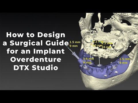 Planning and Designing a Surgical Guide for an Implant Overdenture in DTX Studio