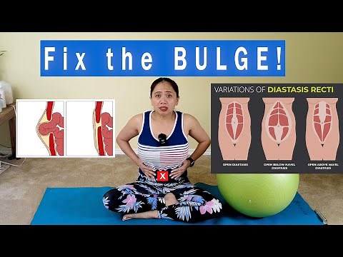 5 BEST Ways And Exercises to Fix the BULGE for GOOD! Abs Separation due to Hernia Diastasis Recti