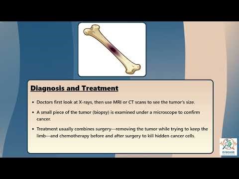 Osteosarcoma Explained Causes, Symptoms and Treatment, All Insights