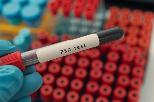 These men are at high risk for prostate cancer – so why aren’t they being screened?