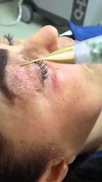 Jett Plasma Lift Medical - Blepharoplasty (noninvasive)