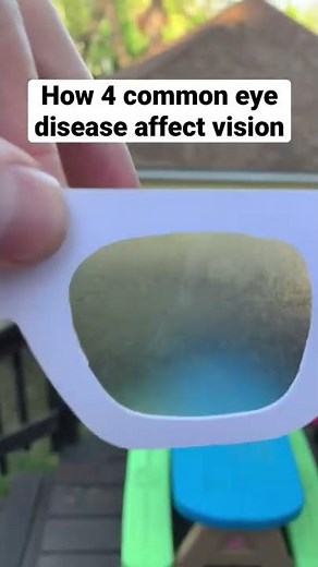 Eye Diseases Vision Simulation
