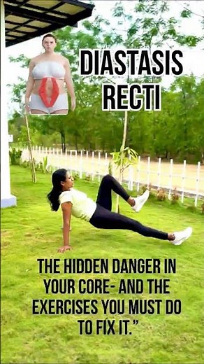 Diastasis Recti: How Serious Is It? Safe Exercises You Need to Know!