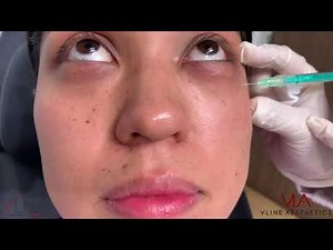 Eye Jelly Roll Injection