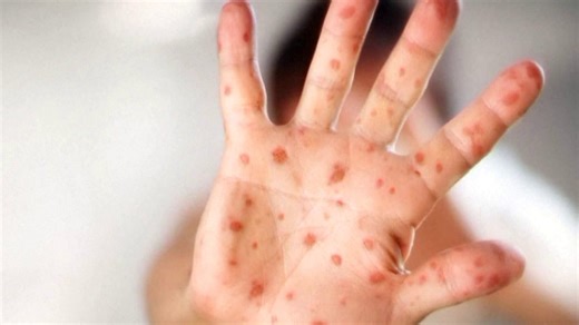 Case of measles connected to Springfield-Greene County National Airport