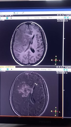 #ressonanciamagnetica #radiology #radiologia #head#glioblastoma #encefalo #oncologia #mri#tecnologyradiology Grau 4: o tipo mais agressivo de tumor cerebral, conhecido também por glioblastoma multiforme. Em geral costuma aparecer após os 50 anos, mas a tendência observada pela medicina é que essa faixa etária está caindo. O câncer cerebral grau 4 pode ser retirado com cirurgia, mas pede necessariamente a radioterapia e a quimioterapia após o procedimento. O tumor grau 4 raramente é retirado comp