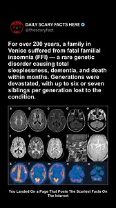 For over two centuries, a family in Venice suffered from an extremely rare and devastating genetic disorder known as Fatal Familial Insomnia (FFI). This inherited prion disease causes progressive sleeplessness that worsens over months, leading to dementia, physical deterioration, and death. Sleep becomes increasingly fragmented until the brain can no longer perform its basic restorative functions, ultimately resulting in multi-organ failure. Generations of the family were ravaged by FFI, with as