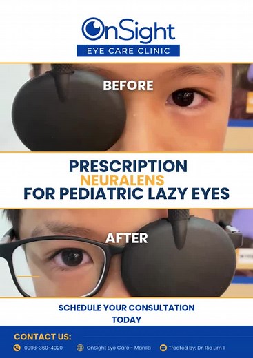 Understanding Binocular Vision Dysfunction in Children