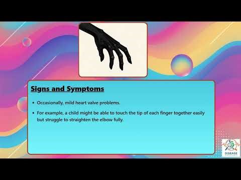 Beals Syndrome Explained Causes, Symptoms and Treatment, All Insights