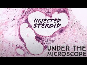 Steroid injection under the microscope (kenalog with giant cell reaction in hypertrophic scar) short