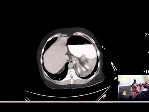 CT Gastric Volvulus Case Discussion by Radiologist