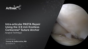 Intra-articular PASTA Repair Using the 3.9 mm Knotless Corkscrew® Suture Anchor