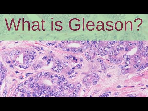 What is Gleason Grading and How Does it Work? - Pathology mini tutorials