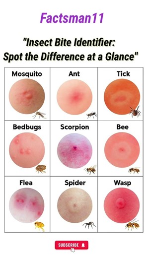 "Insect Bite Identifier: Spot the Difference at a Glance"#edit #shortsfeed #usa