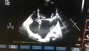 17K views · 256 reactions | Case 54 : l - Transposition of Great Arteries and an Ebstein Deformity of Left sided Tricuspid Valve ( The Ventricles are positioned side by side , Aorta is to the left and Anterior to PA) Echo Report Congenital Heart Disease l - TGA( IVC to RA to LV to PA / PV's to LA to RV to AO), Ebstein deformity of Left sided TV , Moderate TR , Dilated LA & RV, Intact IAS & IVS , Good Ventricular function, | Interesting cases in Echocardiography | Facebook