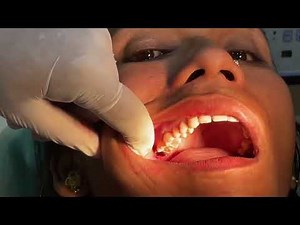 3rd Molar Extraction -18,48 Full Procedure #extraction