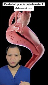 🔴 ¿Dolor menstrual intenso? 👉 Podría ser más que un simple cólico... ⚠️ La adenomiosis es una condición donde el tejido del endometrio invade el músculo del útero. 💥 Causa sangrados abundantes, infertilidad y mucho dolor. 🔍 Identificarla temprano puede cambiar tu calidad de vida. 📲 ¡Comparte este video y etiqueta a alguien que necesite verlo! #Adenomiosis #DolorMenstrual #SaludFemenina #Infertilidad #Ginecología #CicloMenstrual #MujerSaludable #ConsultaGinecológica #DrEmmanuelCastillo #Úter