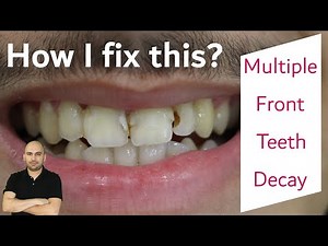 Front Teeth Refilling | How Dentist Remove Tooth Decay? | Front tooth caries repair.