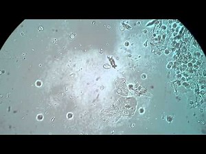 Trichomonas in urine wet mount 400x