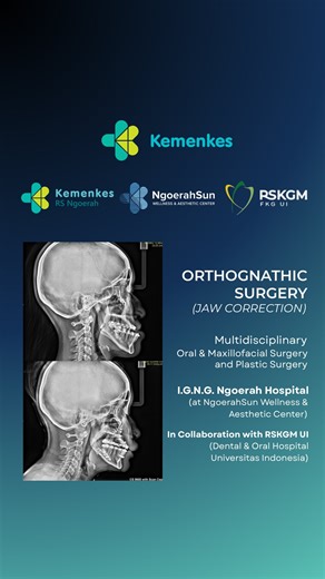 NgoerahSun Wellness & Aesthetic Center on Instagram: "Orthognathic Surgery Pilot Project Under the supervision of the Ministry of Health of the Republic of Indonesia, this pilot multidisciplinary orthognathic surgery program was conducted at NgoerahSun Wellness & Aesthetic Center, RSUP Prof. Dr. I.G.N.G. Ngoerah (RS Ngoerah), in collaboration with RSKGM Universitas Indonesia. This procedure marks the first collaborative project between Oral & Maxillofacial Surgery and Craniomaxillofacial Plastic