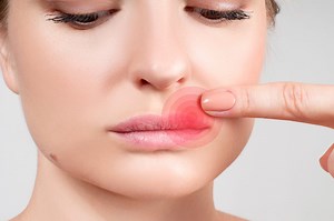 How to Get Rid of That Annoying Cold Sore Fast