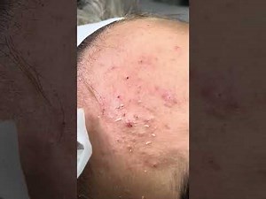 acne blackhead removing