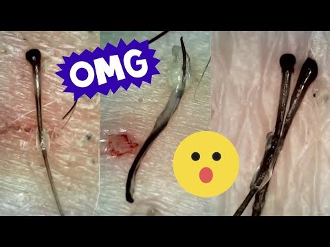 Super Satisfying Ingrown Hair Removal - BIG Juicy Roots Galore! Hair Plucking Under the Microscope!