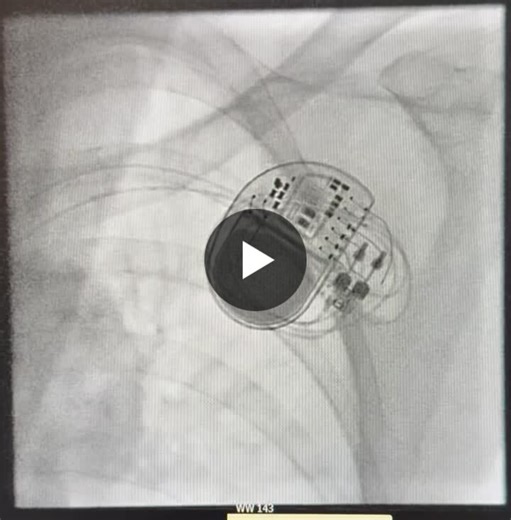 Conduction system pacing - Medtronic 3830 lumenless lead, left bundle branch area pacing and Bachmann bundle pacing at Sarawak Heart Centre with Dr Koh KT. Excellent LVAT and shortened P-wave… | Chiang Kit Hou