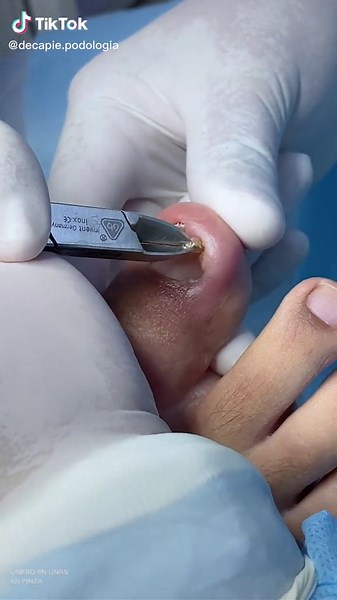 Uñeros en uña en pinza #uñero #uñeros #fy #fypシ #podolo #per #pe