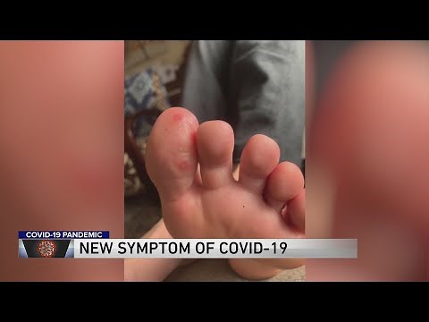 Dermatologist warn of new possible symptom: 'COVID toes'