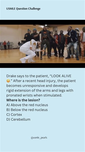 USMLE High-Yield Questions on Instagram: "Drake told bro “LOOK ALIVE 😳” and he hit the full body extension pack 💀 Which neuro level is cooked here?? ⸻ Explanation This patient is showing decerebrate posturing, which is defined by: • Extension of arms and legs • Pronation of wrists • Jaw clenching • Occurs with severe injury below the red nucleus (midbrain/upper pons) Decerebrate = extensor posture → lower, more severe brainstem damage. Why the others are wrong A) Above the red nucleus Would ca