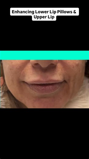 Lip filler 1 ml (with 0.5 ml injection numbing). #Lip #filler #lips #beauty #love | Iconic Laser