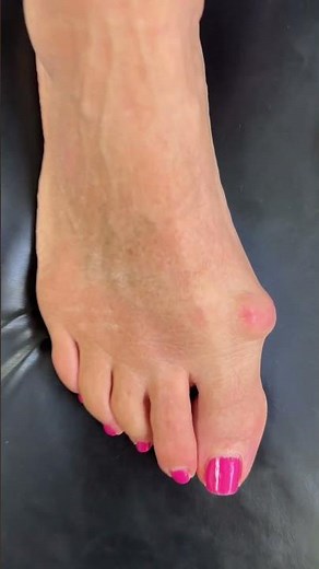 Minimally invasive bunion surgery: Finally a fast recovery!